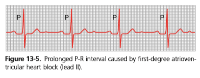 Heart Block And Its Types - Medical Study Zone