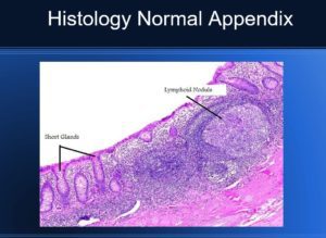 Pathology of Acute Appendicitis - Its Etiology, Morphology, Gross ...