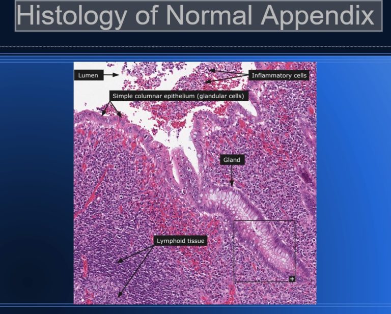 Pathology of Acute Appendicitis - Its Etiology, Morphology, Gross ...