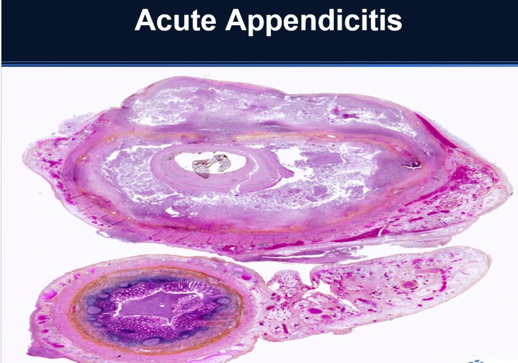 Pathology of Acute Appendicitis - Its Etiology, Morphology, Gross ...