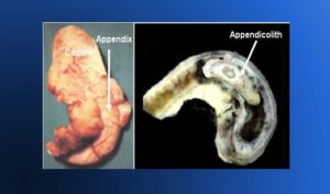Pathology of Acute Appendicitis - Its Etiology, Morphology, Gross ...