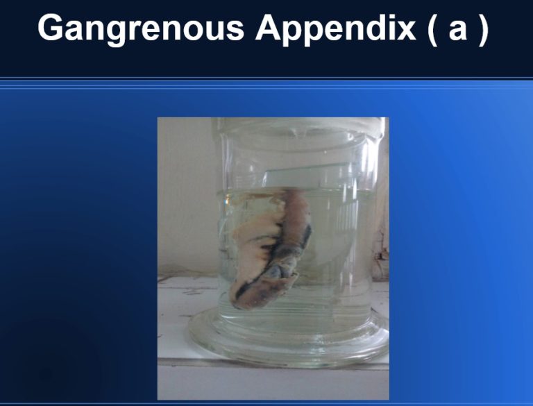 Pathology of Acute Appendicitis - Its Etiology, Morphology, Gross ...