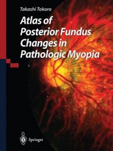 Atlas of Posterior Fundus Changes in Pathologic Myopia PDF Free Download - Medical Study Zone